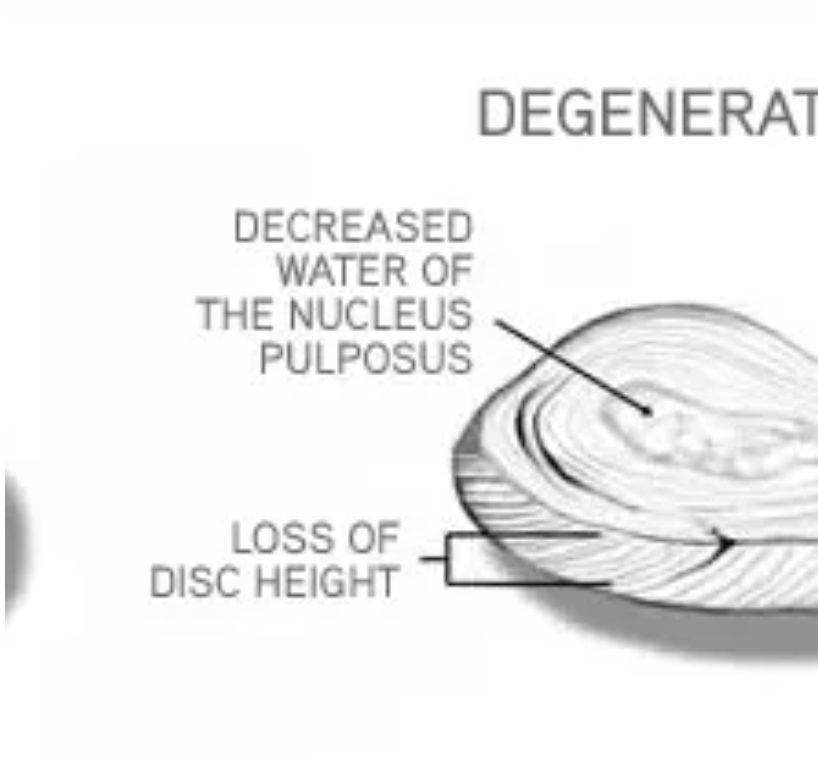 Herniated Disc Physical Therapy Seattle - Union Physical Therapy